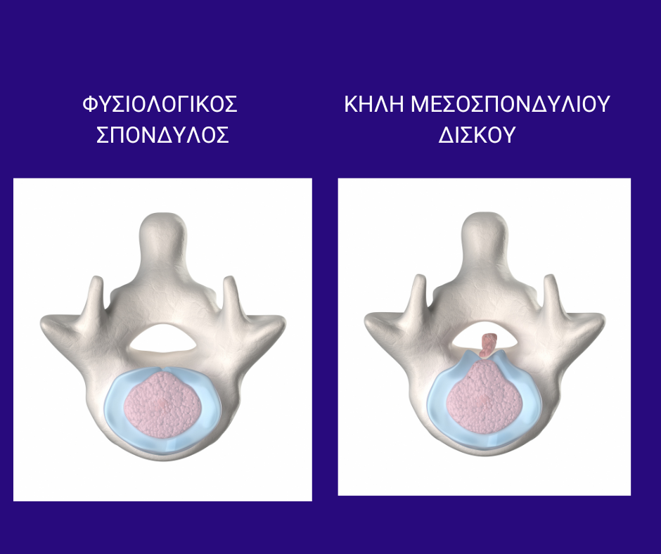 Κήλη μεσοσπονδύλιου δίσκου-Σπονδυλική στένωση | Νευροχειρουργός Νίκος ...