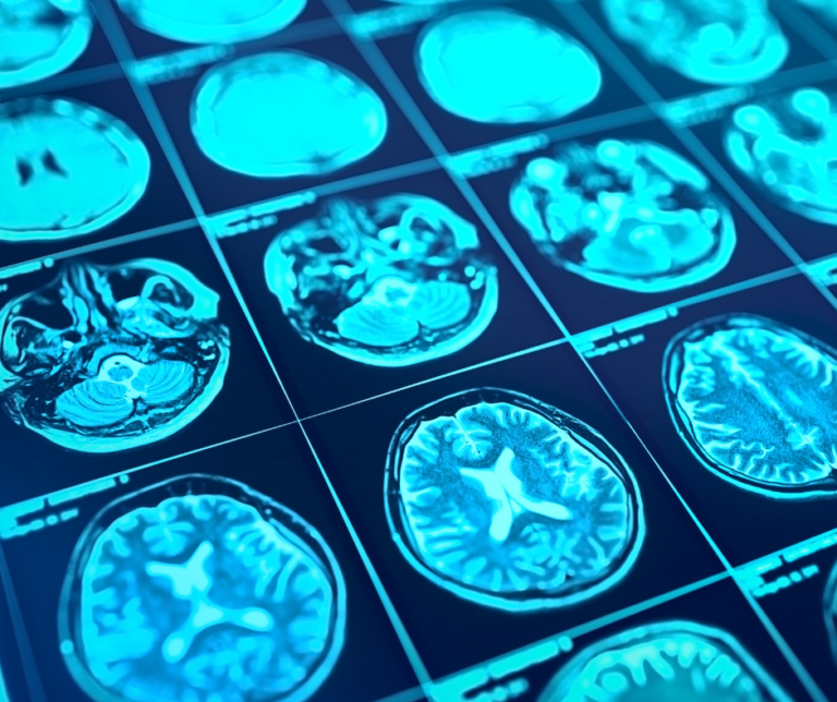 Λοιμώξεις Εγκεφάλου και Νευρικού Συστήματος | Νευροχειρουργός Νίκος ...